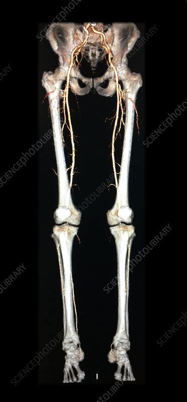 3d Cta Legs Stock Image C043 0274 Science Photo Library