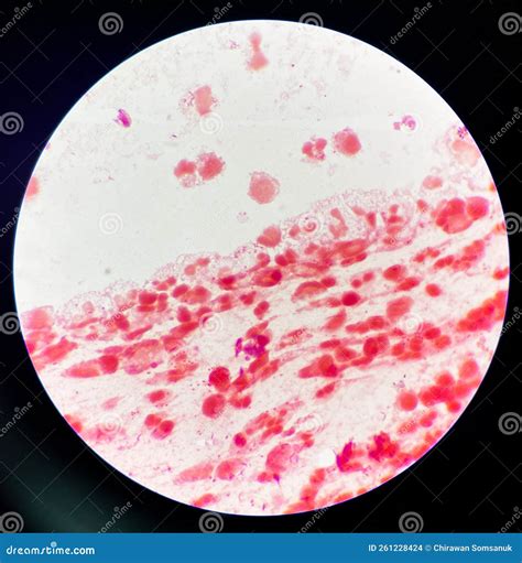 Gram Negative Diplococci Gonorrhea