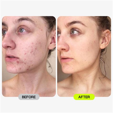 Glotech™ Mask Collar Red Light Therapy Led Esthetics