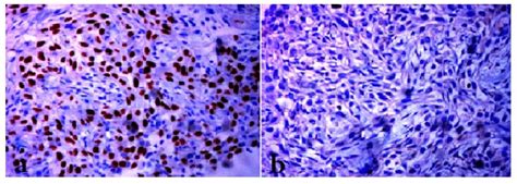 Squamous Cell Carcinoma Positive For P40 A Lacking Expression Of