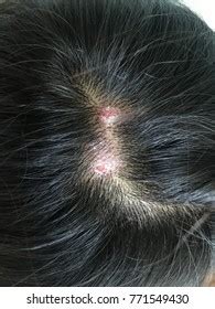 Scalp Fungus Immagini Foto Stock E Grafica Vettoriale Shutterstock