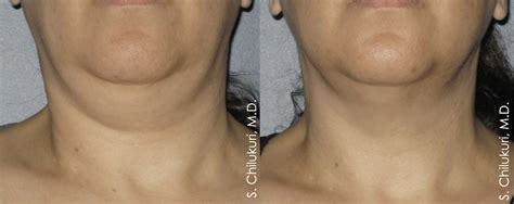 Agnes Rf Microneedling Archives Refresh Dermatology