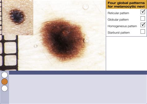 Pattern Analysis Dermoscopic Criteria For Specific Diagnoses Plastic