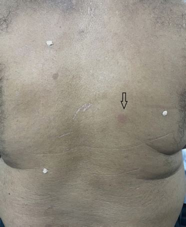 Various Techniques For Marking Patch Test Sites Indian Journal Of Dermatology Venereology And