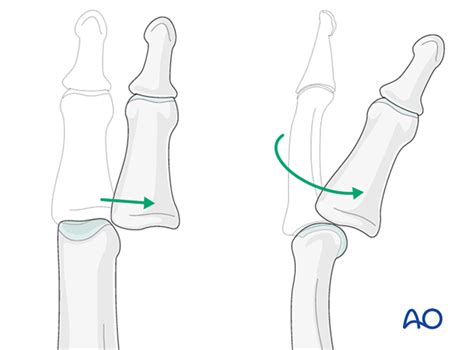 Dislocation And Fracture Dislocation Of The Proximal Interphalangeal Joint