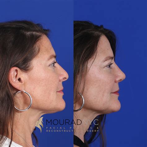 Rhinoplasty And Female Rhinoplasty Facial Plastic Surgeon