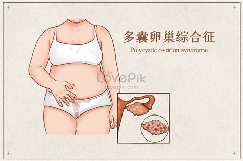 Polycystic Ovary Syndrome Medical Illustration Illustration Image