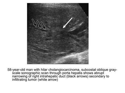 Diagnostic Imaging Of Cholangiocarcinoma Ppt