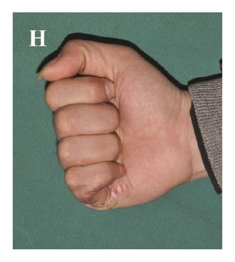 Typical C A S E 2 A A 36 Year Old Man Presented With A Skin Necrosis