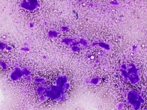 Thick Colloid In A Colloid Nodule Leishman Stain X 40 Download Scientific Diagram