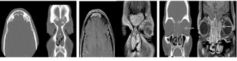 Ct And Mri Showing Frontal Mass With Extension To Right Orbit