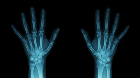 X Ray Phaplu Hospital