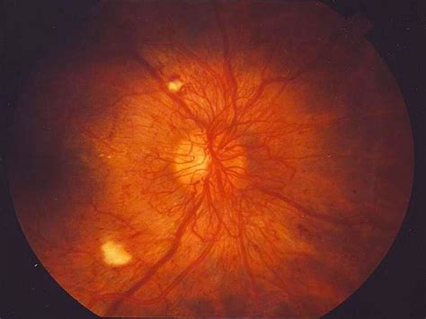 Eye Infection Doxycycline At Charles Dunaway Blog