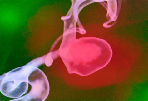 Aneurizma Abdominalne Aorte Uzroci Simptomi Liječenje