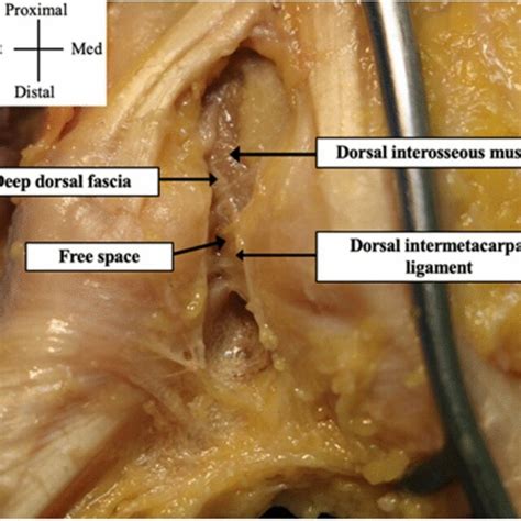 Left Hand Dorsal View Of The Deep Transverse Metacarpal Ligament Download Scientific Diagram