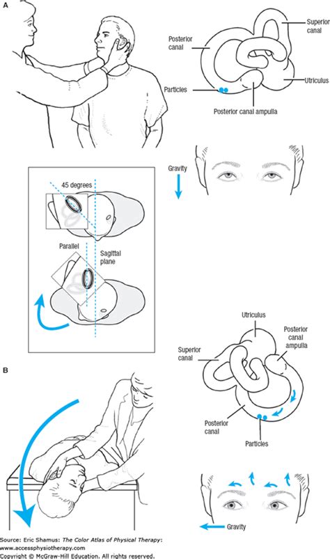 Benign Paroxysmal Positional Vertigo Accessmedicine Network