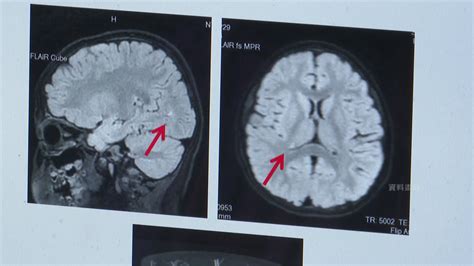 童新冠併發急性腦炎 三總首度找到致病變種病毒