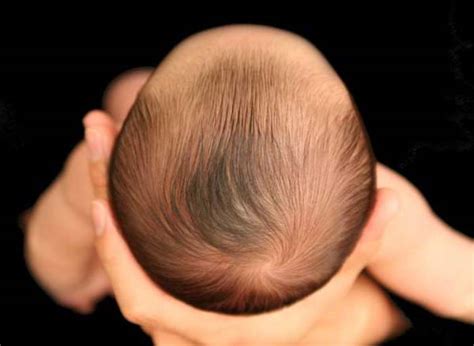 Mi Viejo Maletin Causas De Microcefalia