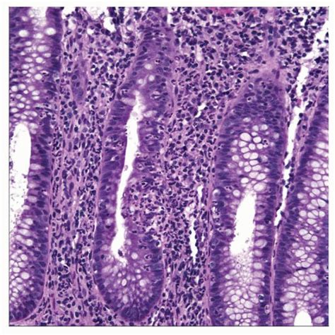 Campylobacter Basicmedical Key