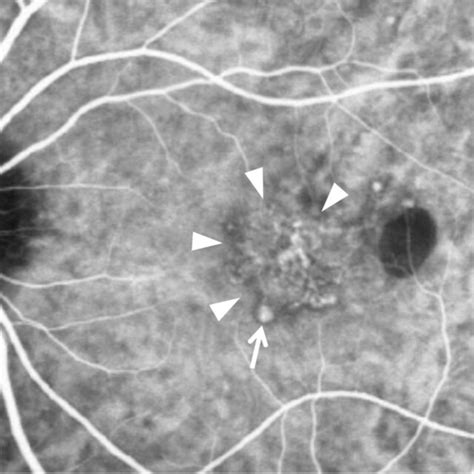 A Representative Figure Showing Polypoidal Choroidal Vasculopathy Download Scientific Diagram