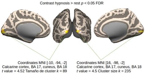 Functional Brain Basis Of Hypnotizability Neurology Hypnosis