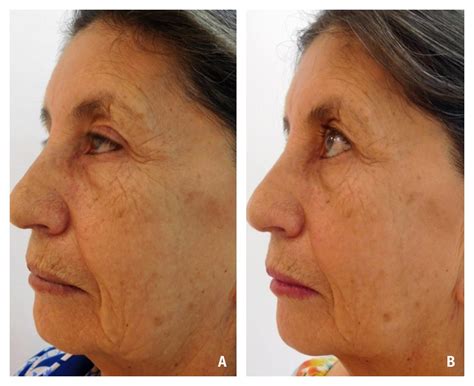 Rejuvenecimiento facial con ácido mandélico tras microdermoabrasión