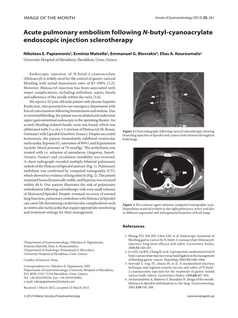 Pdf Acute Pulmonary Embolism Following N Butyl Cyanoacrylate