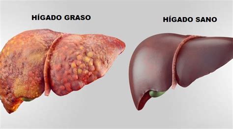Qué Es La Es Esteatósis Hepática O Hígado Graso Portal Salud