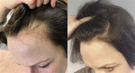 Female Hair Loss Solutions Mhr Clinic Hair Restoration Specialists