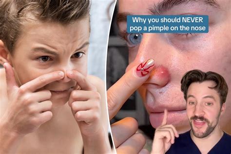 Discover Why Popping Pimples In The Triangle Of Death Could Be Dangerous