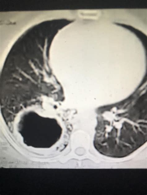 Chronic Lung Abscess Gouda Ellabban
