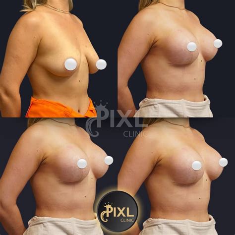 Breast Lift Before And After Pixl Clinic