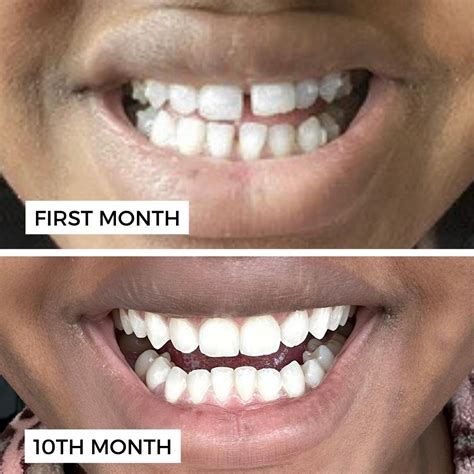 Invisalign Before And After Crossbite