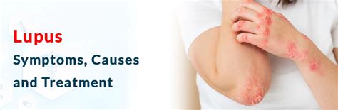 Lupus Systemic Lupus Erythematosus Symptoms Causes And Treatment