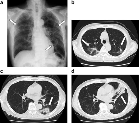 Chest X Ray Film Showing Bilateral Multiple Patchy Opacities A