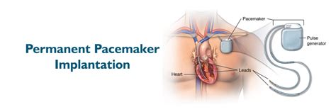 Permanent Pacemaker Implantation Procedure Types And Benefits