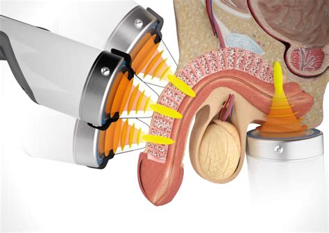 How Much Does Erectile Dysfunction Treatment Cost In Malaysia