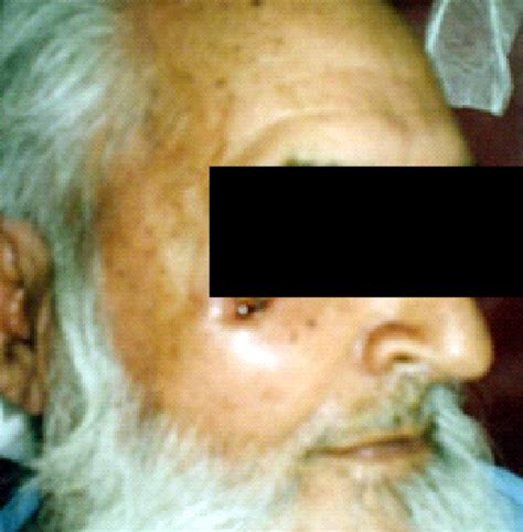 Formation Of Discharging Sinus At The Site Of Lesion Download Scientific Diagram