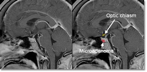 Ctmri Procedures Acromegaly
