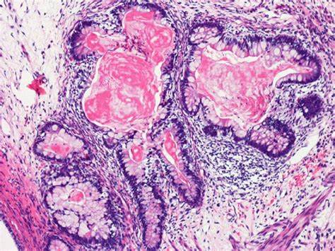 Teratoma Histology Drawing