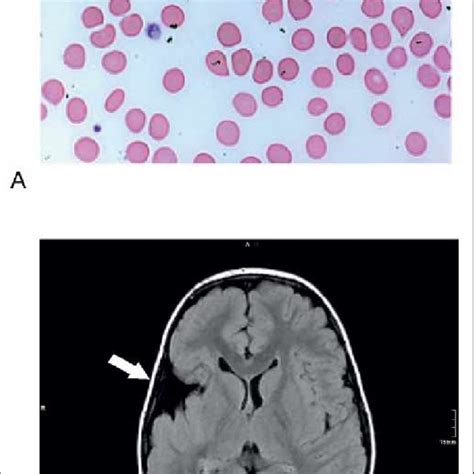 Pdf Deletion Of Human Gp1bb And Sept5 Is Associated With Bernard Soulier Syndrome Platelet