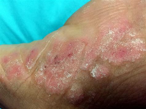 Escamas En La Piel Caspa Qué Es Y Cómo Puedes Prevenirla Y