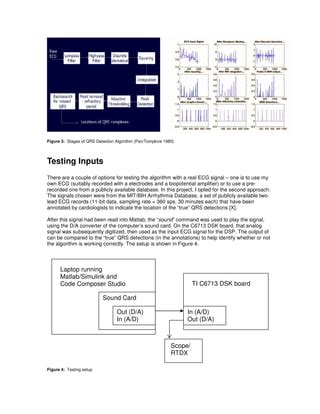 QRS Signal ECG Detection PDF