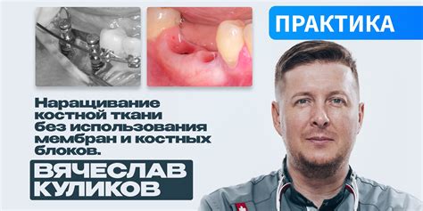Семинар Вячеслава Куликова Наращивание костной ткани без мембран и