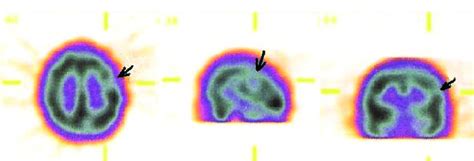 Brain Perfusion Scintigraphy Small Area Of Hypoperfusion In The Left Download Scientific
