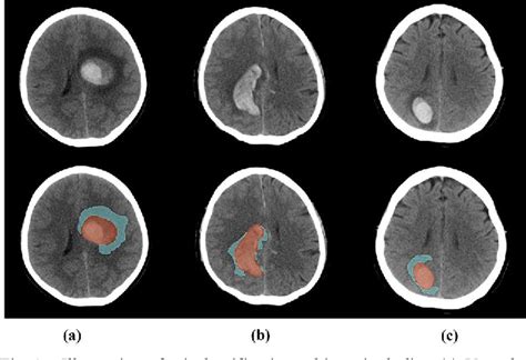 Figure 2 From Classification Of Acute Intracerebral Hemorrhage Using