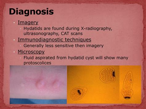 Ppt Echinococcus Granulosus And Multilocularis Powerpoint