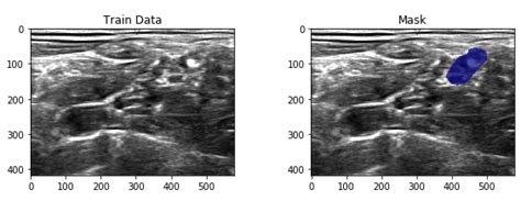 Github Ajaykumar Ultrasound Nerve Segmentation Segmenting The
