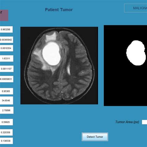 Pdf Brain Tumor Extraction From Mri Images Using Matlab