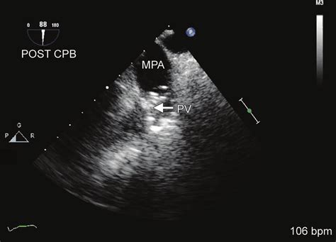 Upper Oesophageal Aortic Arch Short Axis View In A Patient With